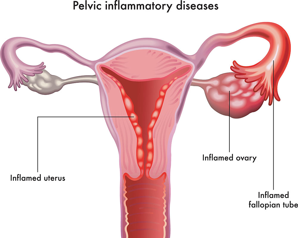 What Causes Pelvic Inflammatory Disease • Moms Memo
